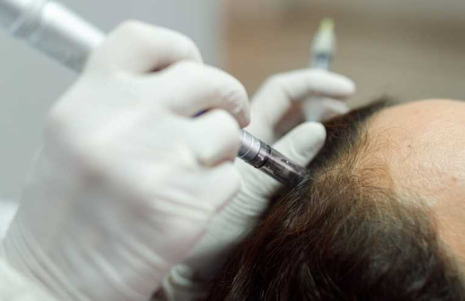Can Microneedling Help With Hair Loss? Experts Weigh In