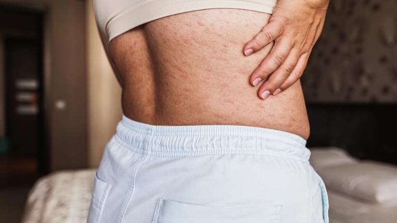 The Hidden Risks of Topical Steroid Use: What You Need to Know
